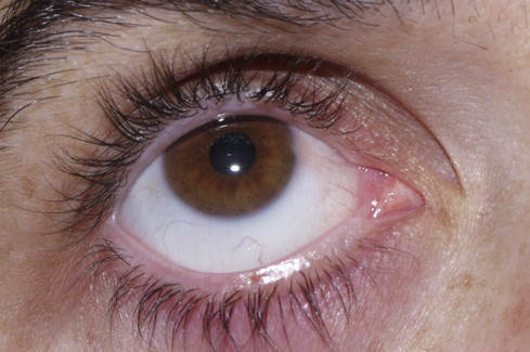 Troublesome lashes - eyeonoptics