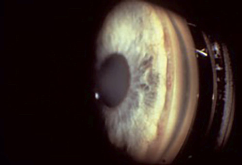 Gonioscopy – a closer look at the angle - nzoptics