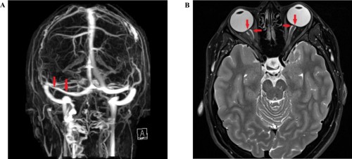 Idiopathic intracranial hypertension - nzoptics