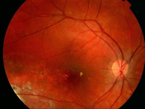 Primary retinal telangiectasia - nzoptics