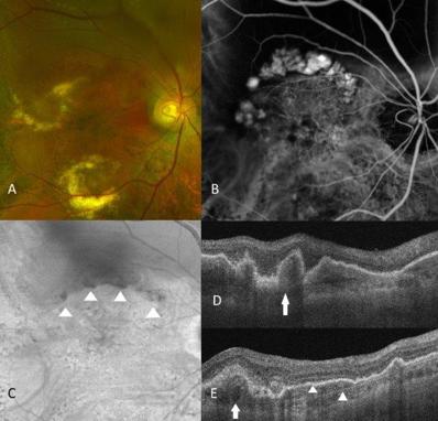 Diagnosis and management of macular polypoidal choroidal vasculopathy ...