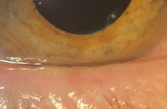 Keratolytic drug for MGD - nzoptics