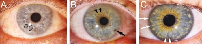The iris in health and disease: part 1 - normal variations and mass ...