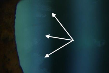 Oh no, the drain is blocked! PXF and glaucoma - nzoptics