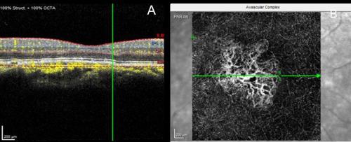 What lies beneath? Nonexudative macular neovascularisation in AMD ...