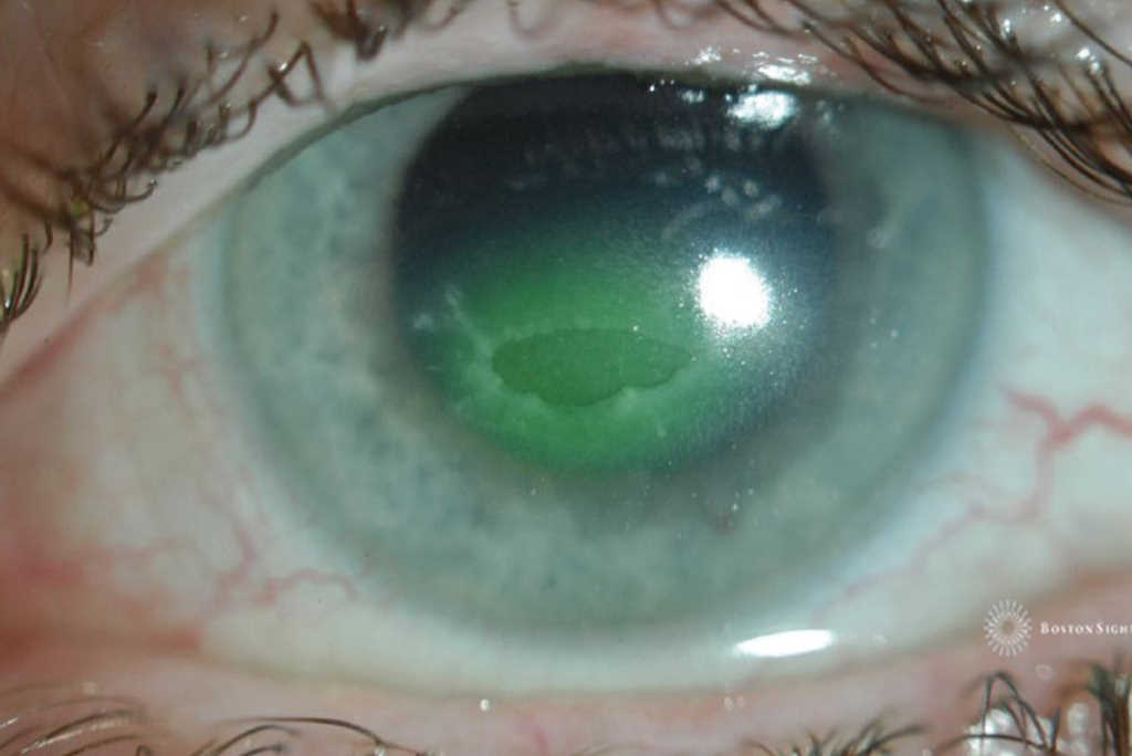 PCED drop trial starts